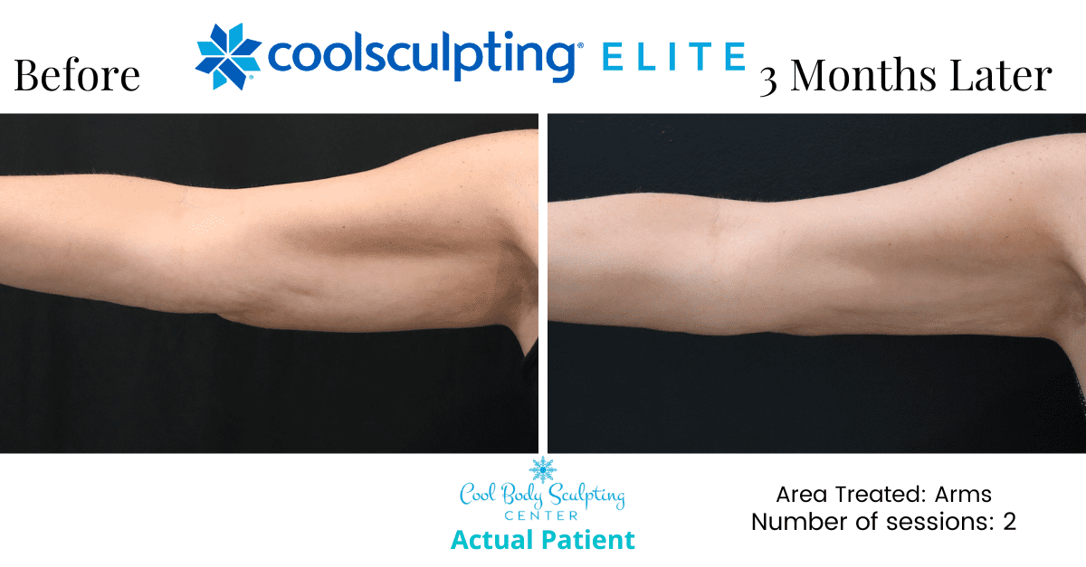 What Is Cool Sculpting? How Does Coolsculpting Work? Virginia Beach VA